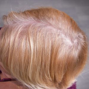 Haar en hoofdhuid problemen